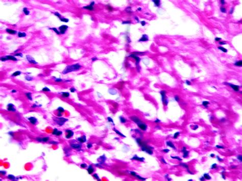 Ulceras Por Criptococosis Comportamiento En Un Paciente Inmunodeprimido Por Medicamentos Piel