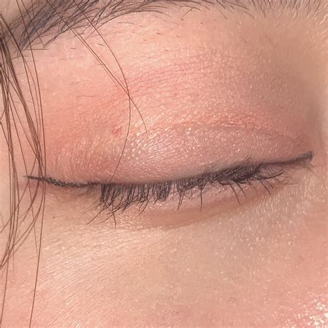 시술 수술 질문 쌍커풀 한지 2년 강남언니 1등 성형수술and피부시술 정보앱