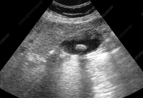 Gallbladder Ultrasound Stones