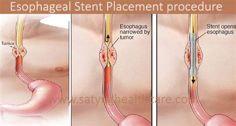 Esophageal Stent Placement Procedure Cost In India