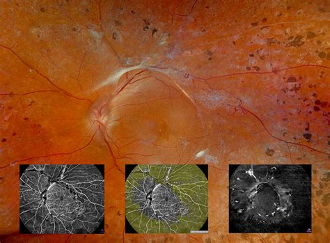 Fibrose Ophtalmologie Hôpital Lariboisière