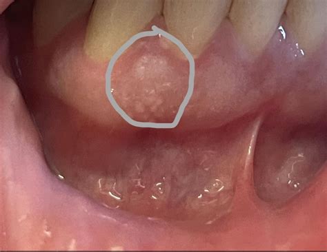 White Patch And Bumps On Gums Rperiodontaldisease