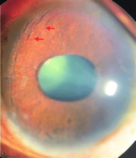 Anterior Segment Slit Lamp Photograph Showing Neovascularization Of