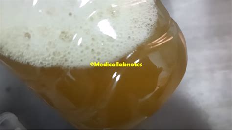 Pleural Fluid Culture And Sensitivity Introduction Report Clinical