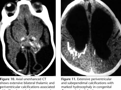Cmv Periventricular Calcification