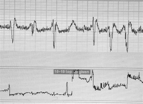 Variable Decelerations