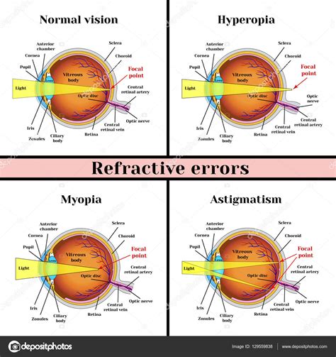 Myopia Hyperopia Astigmatism