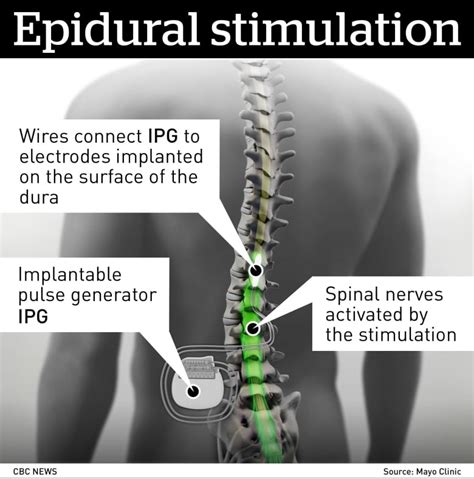This Is Not A Magic Wand Spinal Stimulation Used On Humboldt Bronco Promising But In Early