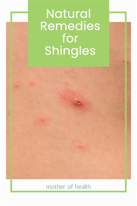 Natural Remedies For Shingles Natural Remedies Essential Oils For
