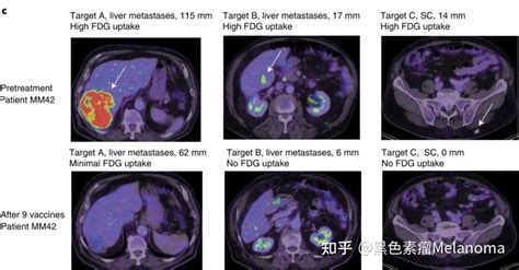 【快讯】最期待的黑色素瘤治疗性肿瘤疫苗io102 Io103完成三期临床招募 知乎