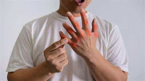 Warning Signs That You Have High Uric Acid