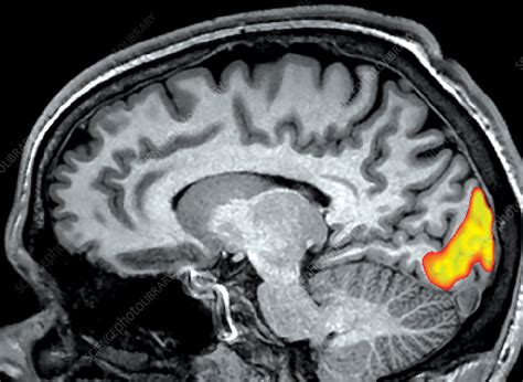 Fmri During Visual Stimulation Stock Image C030 6407 Science