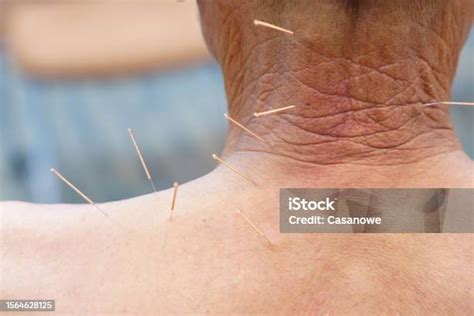 의사는 침술에서 인체에 바늘을 붙입니다 중국 전통 의학 침술 치료 침술에 대한 스톡 사진 및 기타 이미지 침술 한 명의 여자만 건강관리와 의술 Istock