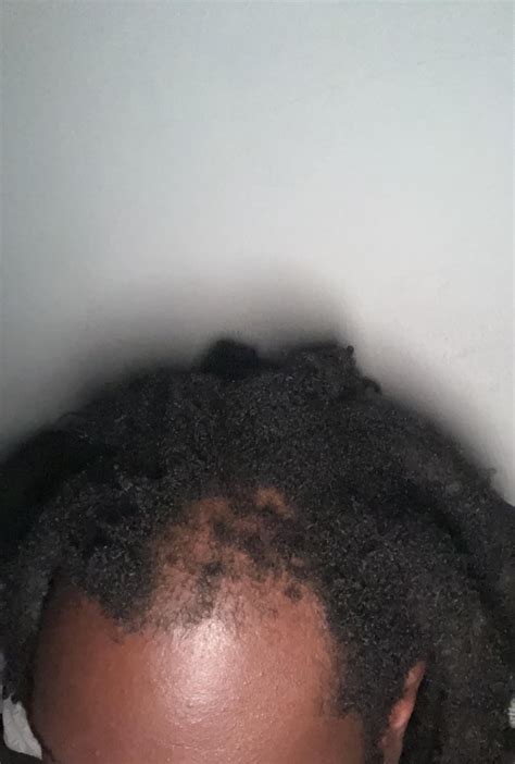 Can Someone Please Help Me Out R Alopecia Areata