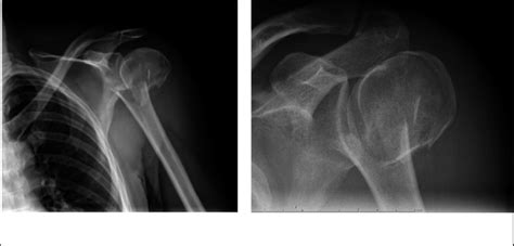 Displaced Phf With 3 Fragments According To Neers Classification Download Scientific Diagram