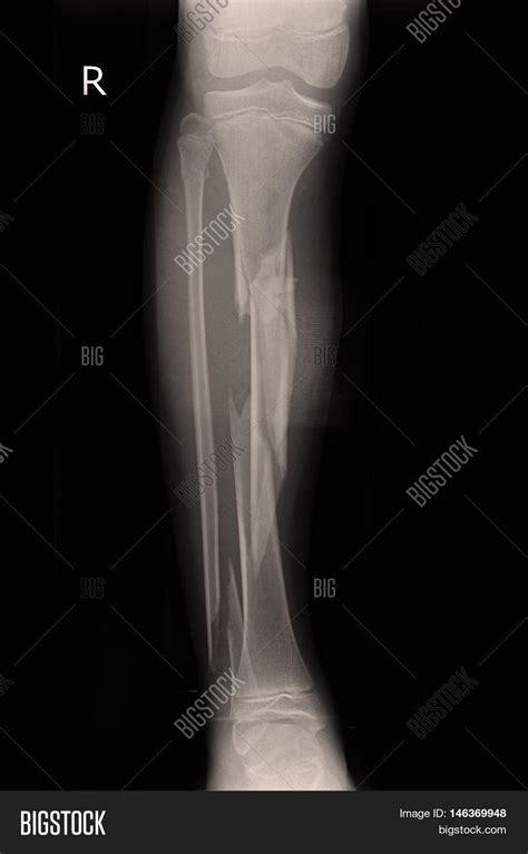 Broken Tibia X Ray
