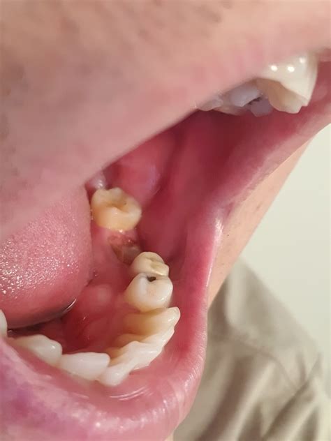 블라인드 헬스·다이어트 치아 이빨이 빠졋어요 사진첨부혐주의 치과 선생님 또는 간호사 샘들 계시면 봐쥬세요 ㅠㅠ