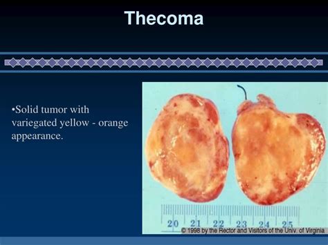 Ppt Ovarian Neoplasms Powerpoint Presentation Free Download Id557783