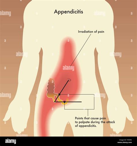 Medical Illustration Showing The Points That Cause Pain To Palpate
