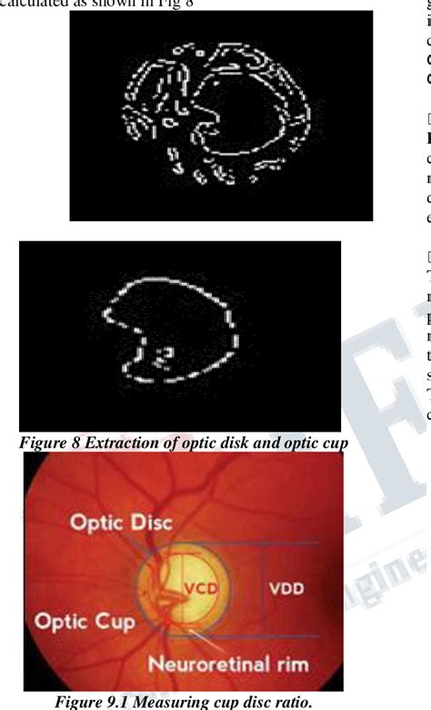 figure 8 from glaucoma detection and its classification using fuzzy c