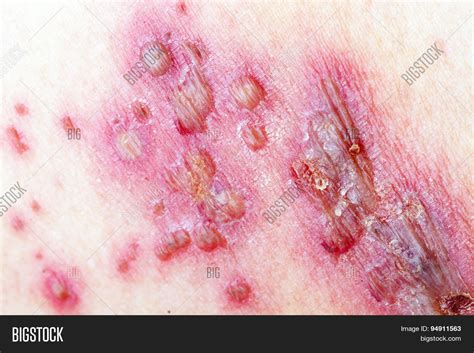 Herpes Zoster Shingles Image And Photo Bigstock