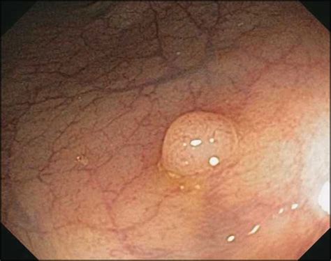 Polyps And Colon Cancer Gastrointestinal Medstudentnotes