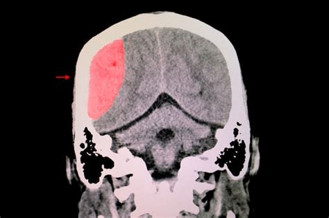 Premium Photo A Brain Ct Scan Of A Patient With Traumatic Injury