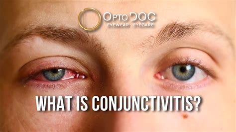 What Is Conjunctivitis Optodoc