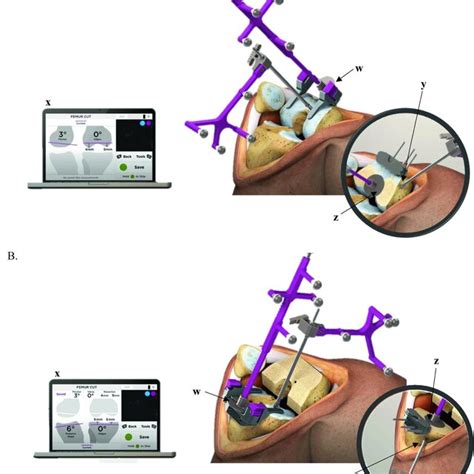 Imageless Computer Navigation Device A With Optical Probe Tracker