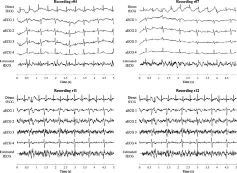 Table 1 From Non Invasive Fetal Electrocardiogram Extraction Based On