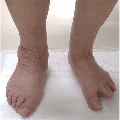 Pdf Arthrodesis For Chronic Lateral Subtalar Joint Dislocation Caused By Posterior Tibial