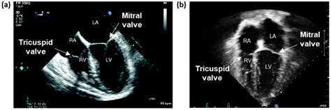 Tricuspid Valve Leaflets