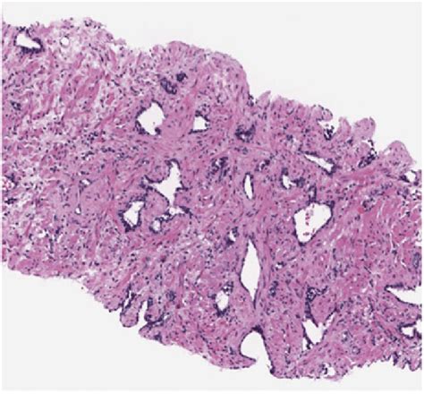 Prostate Atrophy Formalin Fixed Paraffin Embedded Stained With Hande