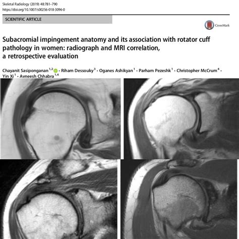 Mri Shoulder Impingement