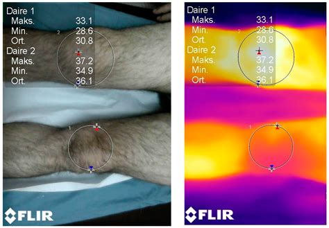 A New Perspective On The Diagnosis Of Septic Arthritis High Resolution Thermal Imaging
