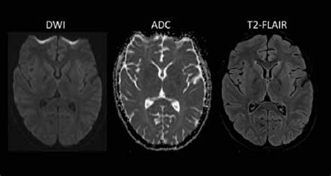 Diffusion Weighted Images Dwi Adc Maps And Axial T2 Flair Weighted Download Scientific