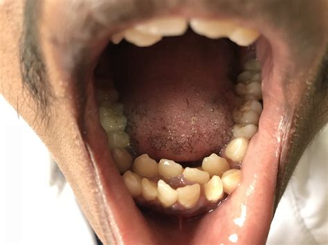 Supernumerary Teeth Hyperdontia Numbering Chart And R