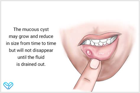 Mucocele Cyst Lower Lip Treatment