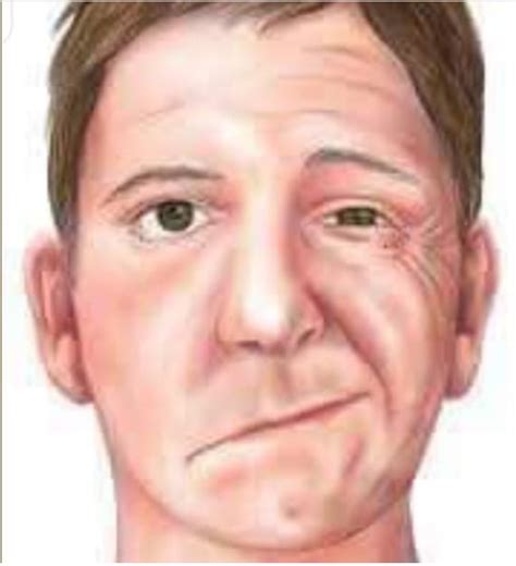 Physiolair Bells Palsy And Elctro Stimulation Effect