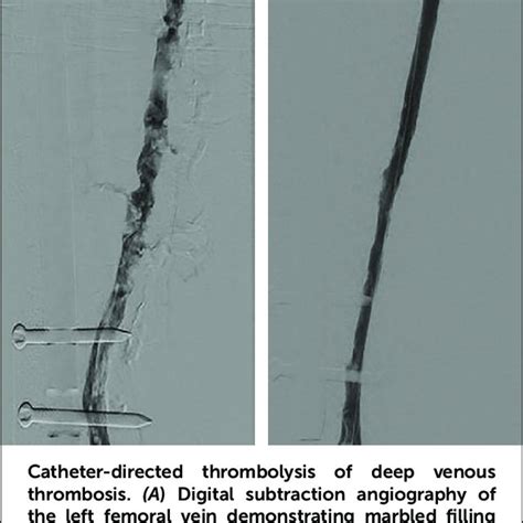 Indications For Transarterial Embolization For Acute Hemorrhage