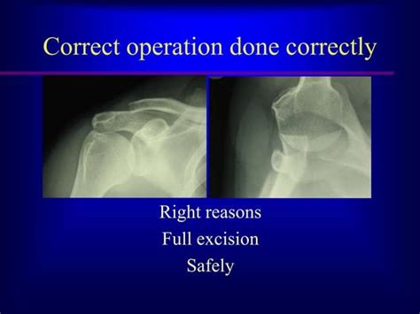 Acj Excision Watanabe India Ppt