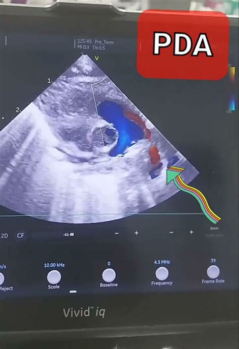 Neonatal Echocardiogram Patent Ductus Arteriosus Pda Short Axis Echo With Doppler Flow