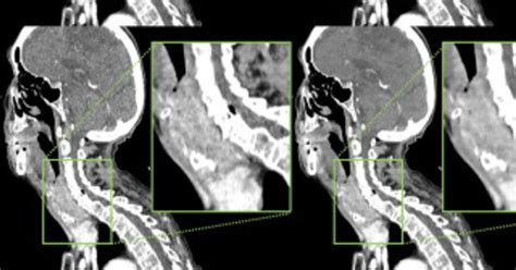 Deep Learning Denoising Software Can Cut Radiation Exposure To 25 Of Conventional Doses During