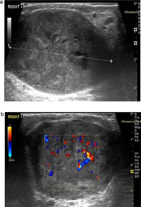 A Scrotal Ultrasound Showing A Well Circumscribed Mass Of Mixed