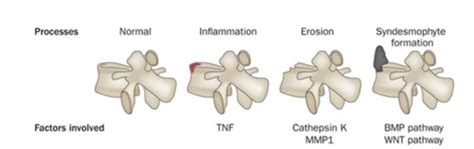 20 Spondyloarthropathies And Other Hla B27 Related Disease Msk Yr2