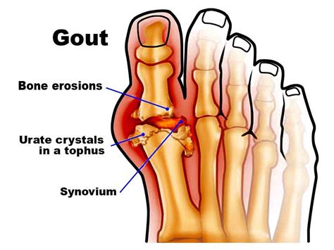 Gout Symptoms Of Gout