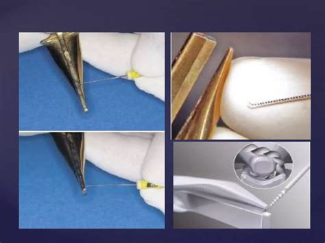 Curved And Dilacerated Canals Pptx