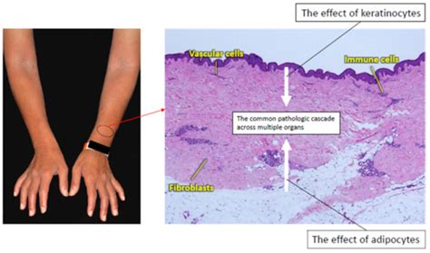 The Pathogenesis Of Systemic Sclerosis An Understanding Based On A