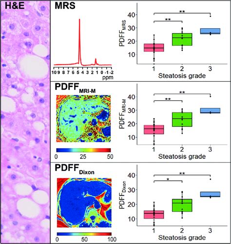 Mrs And Mri Based Pdff Values Vs Histological Steatosis Grade As Seen