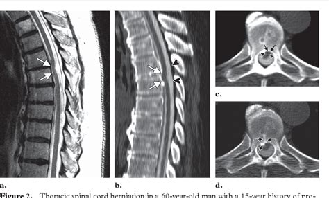 Figure 2 From Imaging Of Idiopathic Spinal Cord Herniation Semantic Scholar